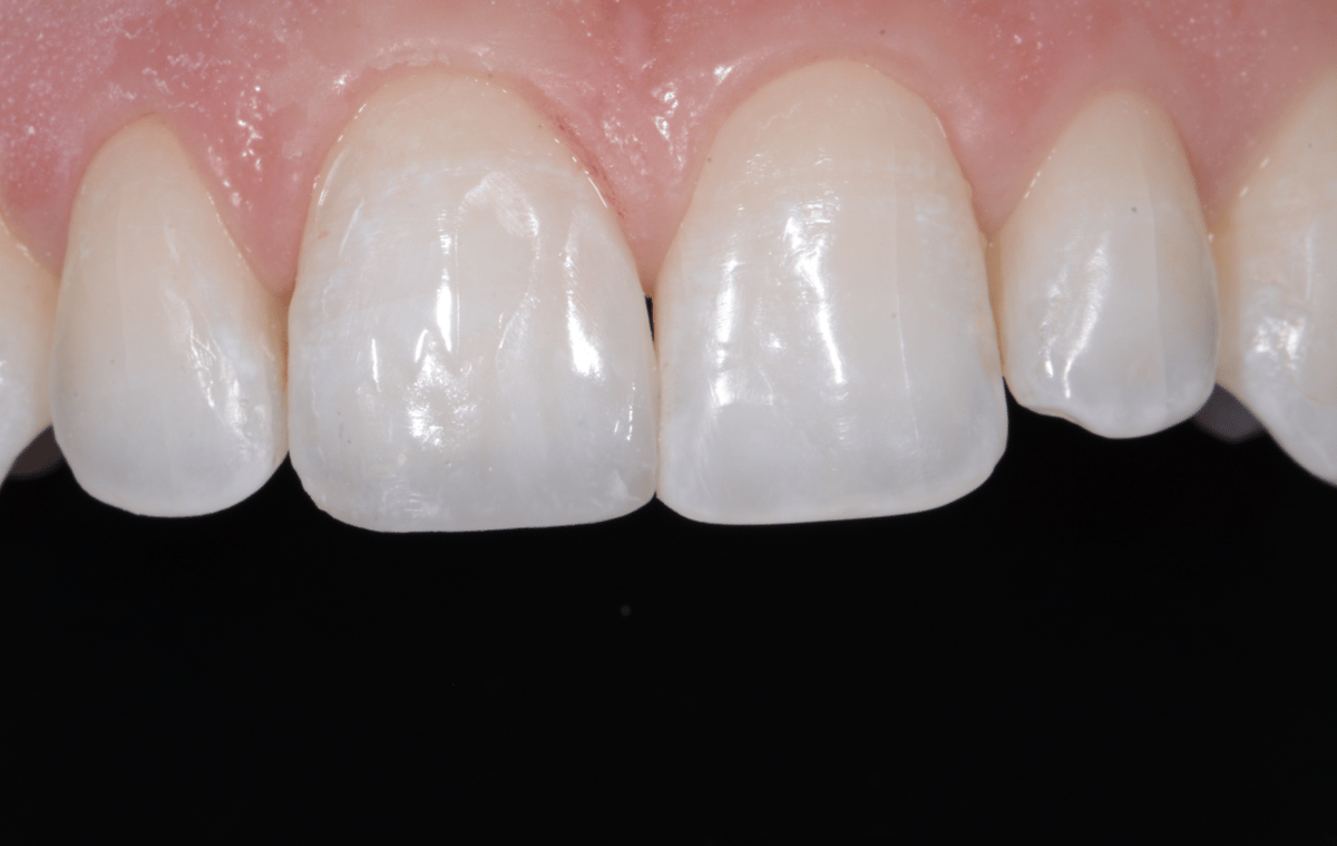 Advanced Techniques for Anterior Composite Restorations and Teeth Whitening