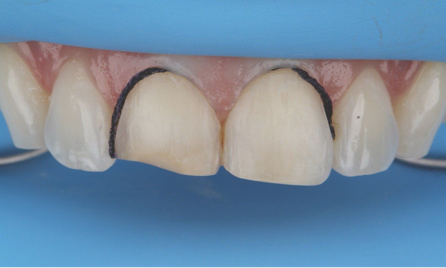 Clinical Guide: Class II Restoration of Maxillary Central Incisors